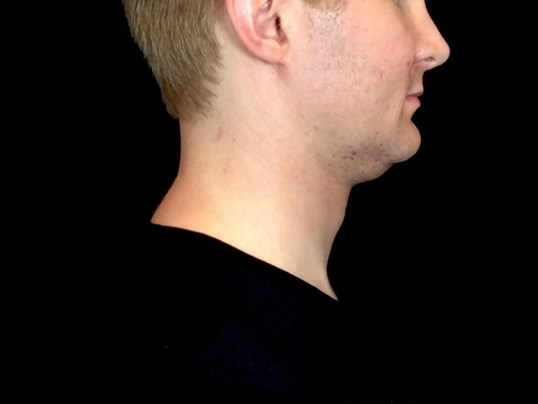 CoolSculpting | Nonsurgical Liposuction Alternative | ZO Skin Centre Dallas